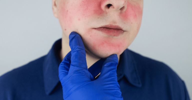 Cuperosis: causas, síntomas y tratamiento – Instituto de Fotomedicina
